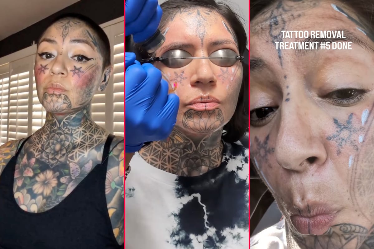 Ink addict undergoes dramatic face tattoo removal: "Feels like walking ...