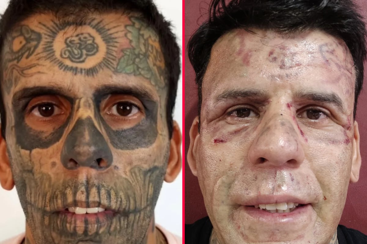 Man who inked 90% of body undergoes mind-blowing tattoo removal process