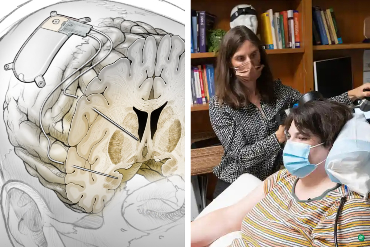 Brain pacemaker cures severe depression from the University of ...