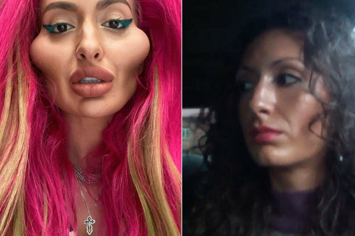 The world's biggest cheekbones? Instagram model is addicted to ...