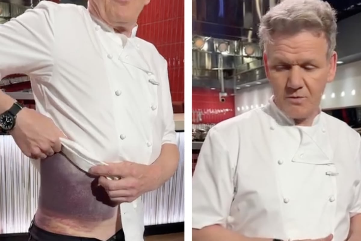 Celebrity chef Gordon Ramsay shows shocking photos of bike accident ...