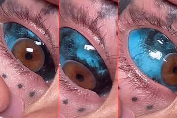 Body mod addict who was almost blinded by ink gets radical new eye tattoo