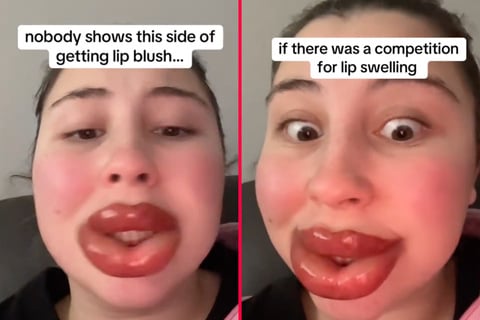 UK girl goes viral after lips swell in massive tattoo blunder: "It was worth it"