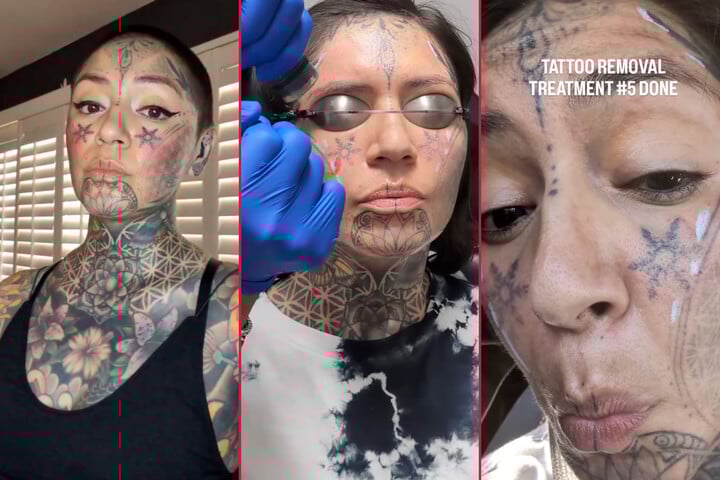 Ink addict undergoes dramatic face tattoo removal: "Feels like walking ...