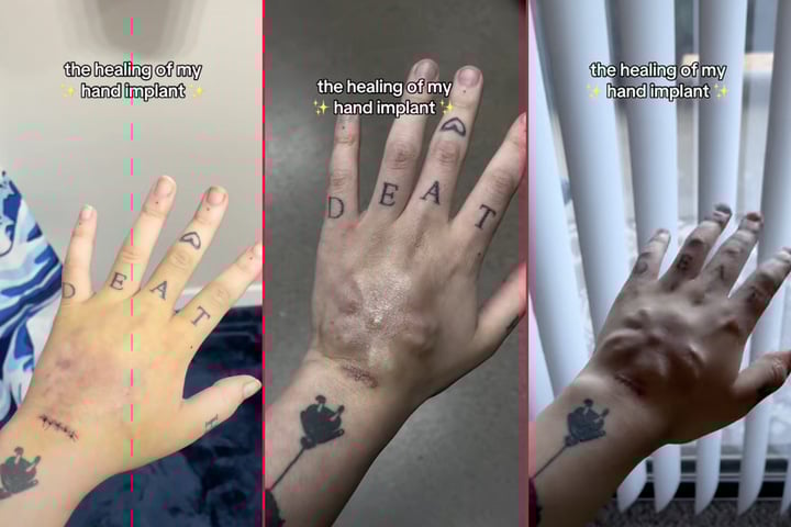 Woman embeds cherry blossom on back of hand in radical body mod