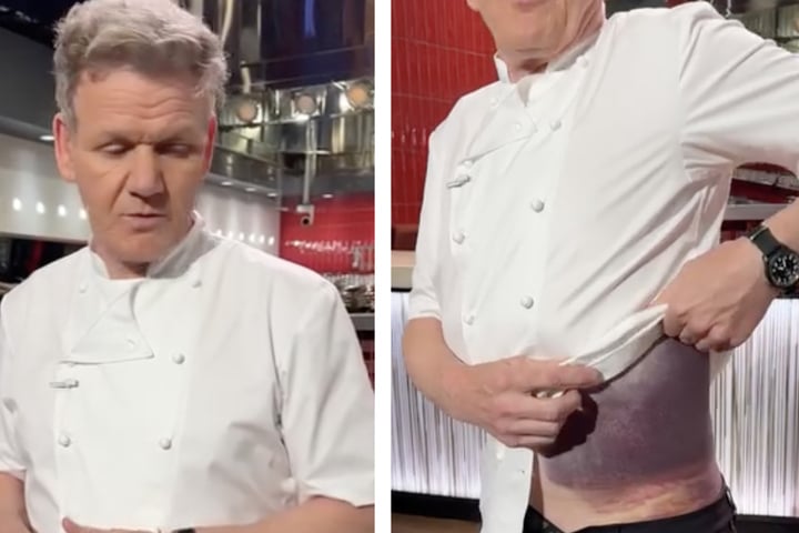 Celebrity chef Gordon Ramsay shows shocking photos of bike accident ...
